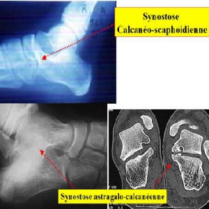 Synostose du tarse