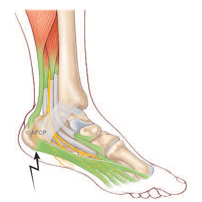 Aponévrosite plantaire
