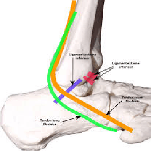 Problème des tendons fibulaires