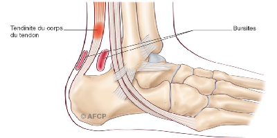 Problèmes Tendon achille