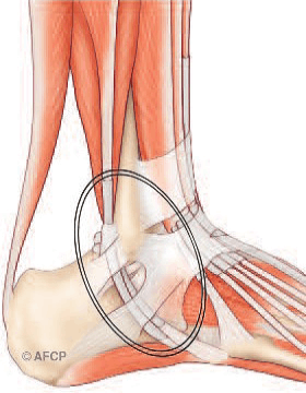 Problème des tendons fibulaires